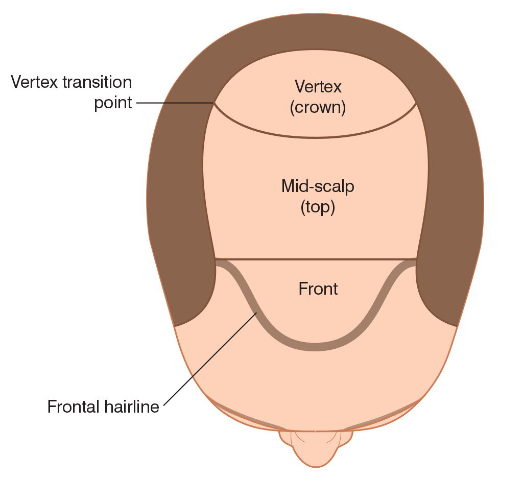 Follicular Unit Hair Transplant 2015 Follicular Unit Hair Transplant 2015