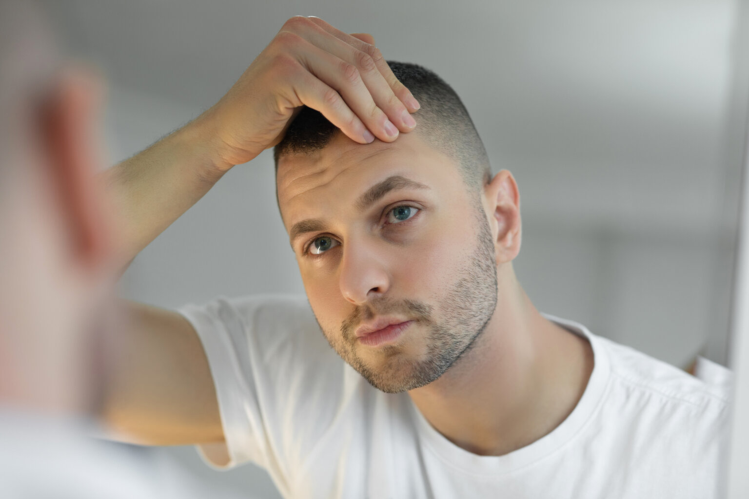 Early Male Pattern Baldness Signs and How to Stop Progression