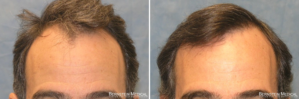 Classification of Hair Loss in Men | Bernstein Medical