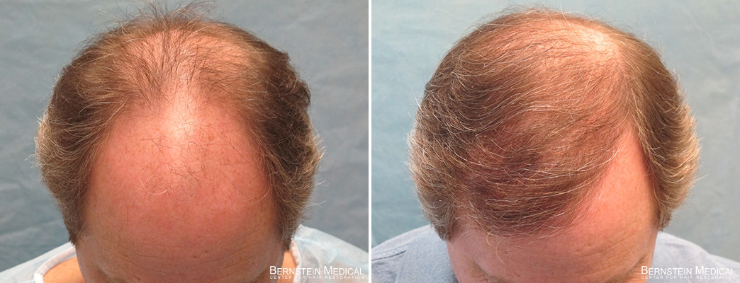 Classification of Hair Loss in Men | Bernstein Medical