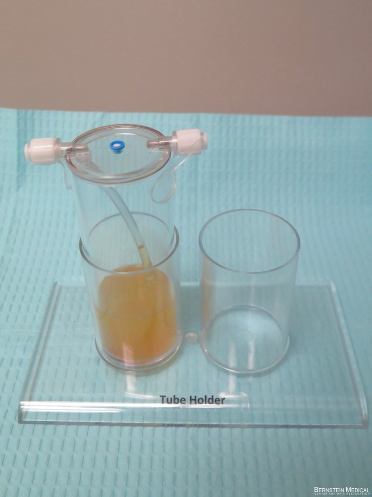 Platelet Rich Plasma (PRP) - Bernstein Medical - Center for Hair ...