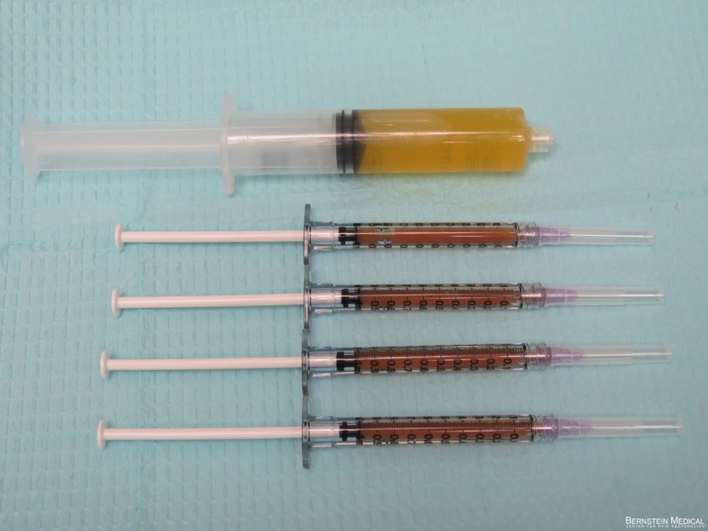 PRP to Treat Hair Loss - Bernstein Medical - Center for Hair Restoration