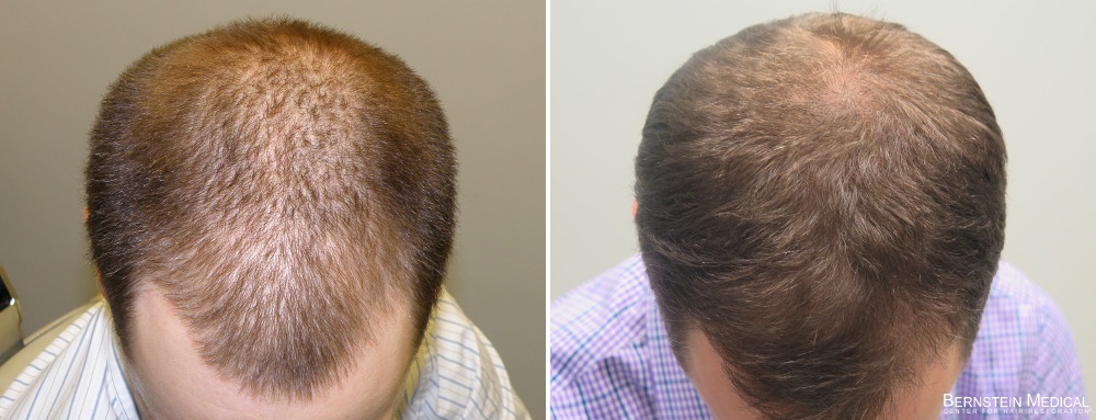Propecia Rogaine Results Before After Photos | Bernstein Medical