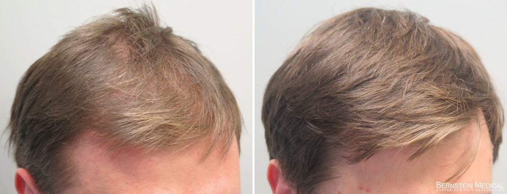 Propecia Rogaine Results Before After Photos | Bernstein Medical